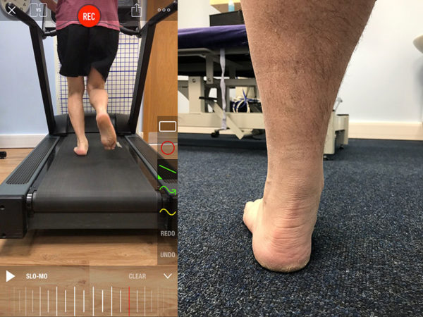 Movement Screening & Gait Analysis | Physiotherapy for Movement Pain ...